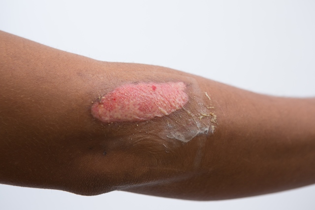 Chirurgische wonden | Hechting en gerichte genezing | Urgo Medical