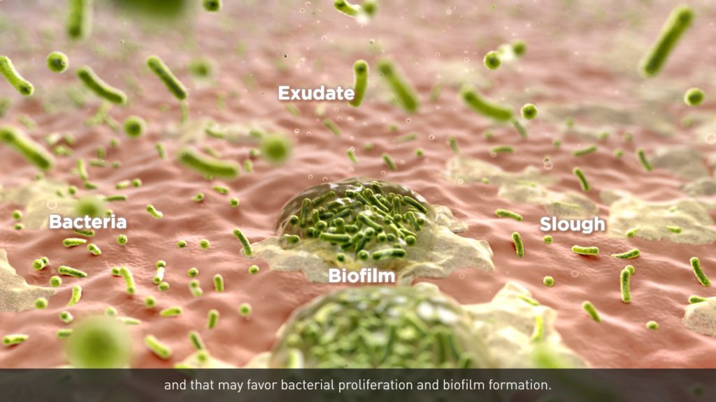 Geïnfecteerde wond of met risico op infectie Archief | Urgo Medical